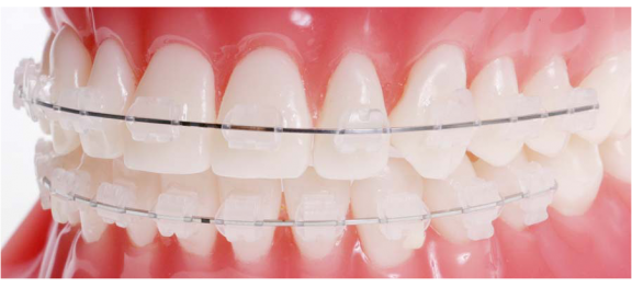 Aparat dentar – Ortodonție - Dental Zen Estetic